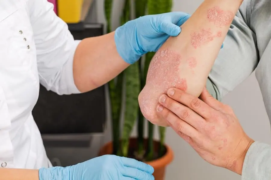 Eczema Specialist In Alexandria Va K Street Foxhall Dc